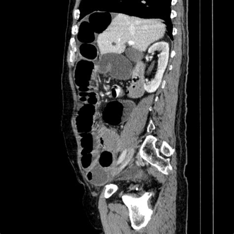 File Small Bowel Volvulus Causing Small Bowel Obstruction Mimicking Intussusception