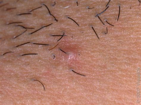 Ingrown Hair Pictures How To Get Rid Of Ingrown Hair