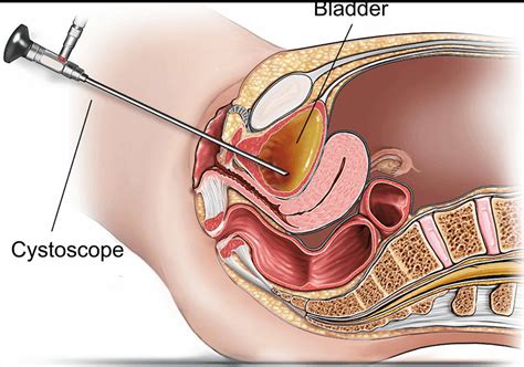 Cystoscopy Demystified What To Expect From This Key Diagnostic