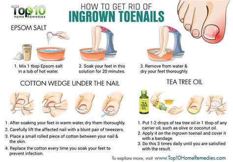 Ingrown Fingernail Treatment At Home