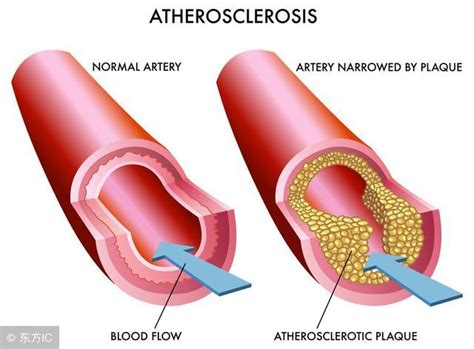 动脉粥样硬化的原因及治疗，吃什么药物可以软化血管？