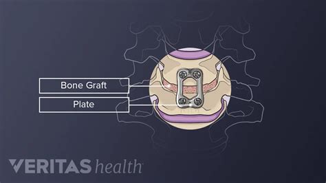 Bone Graft For Spine Fusion