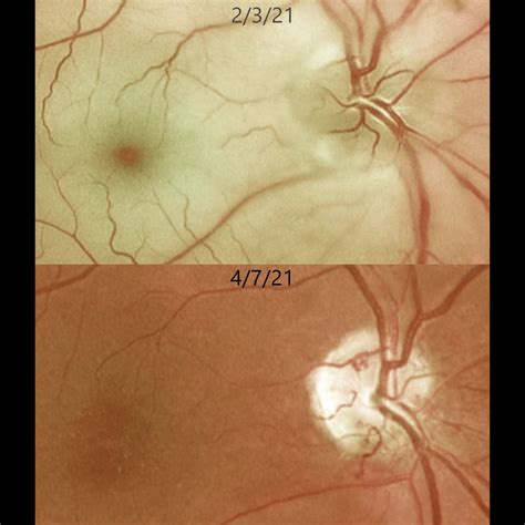 Rwc Retina Rocks On Linkedin Crao Retinalcollateralvessels Retina Optometry Ophthalmology