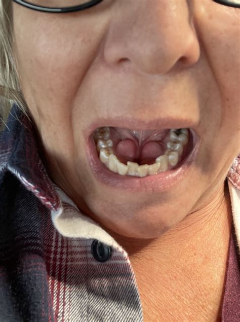 Torus Mandibularis Whatdoesntkillyougirlmakesyoustronger