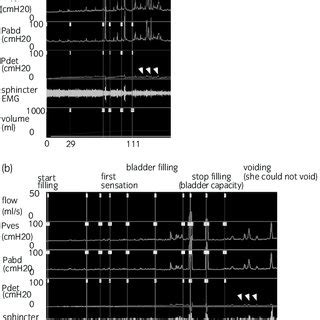 Normal Uroflow Trace In A Female Download Scientific Diagram