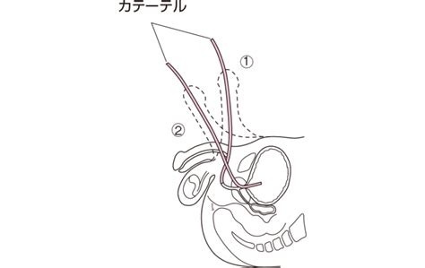 尿道カテーテル挿入(特に挿入困難例に対する対処法) 尿道カテーテル挿入(特に挿入困難例に対する対処法)