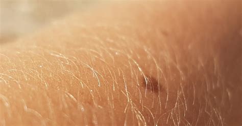 Un Estudio Descubre Los Orígenes De Varios Tipos De Melanoma