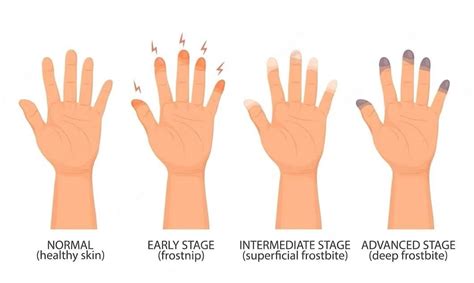 What You Need To Know About Cold Related Emergencies Sos First Aid