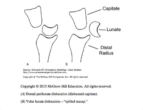 Perilunate And Lunate Dislocation Types