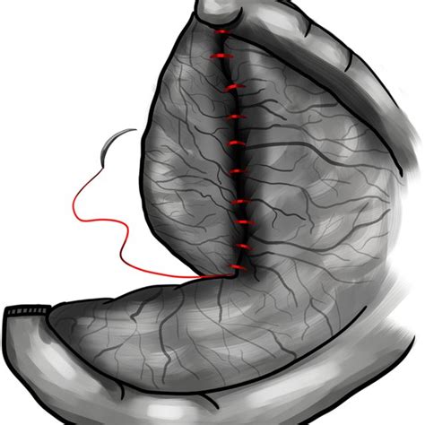 The Aspect Of Mesenteric Defect Closed Download Scientific Diagram