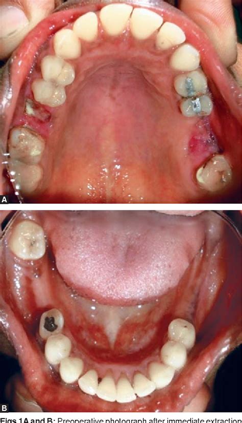 Unilateral Removable Partial Denture