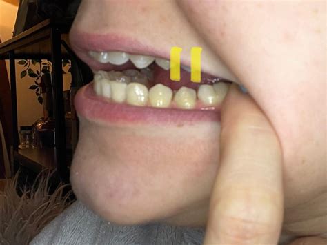 Ipr Gaps Not Closed End Of Refinements R Invisalign