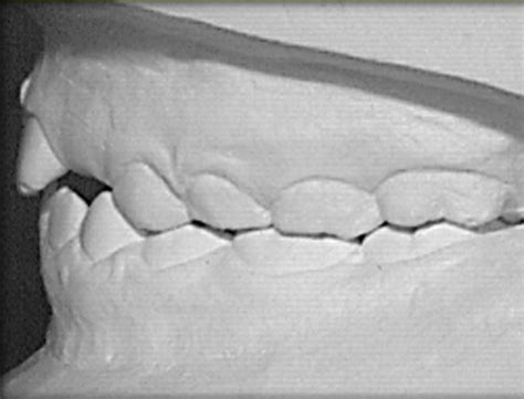 Skeletal Class 3 Cfoo