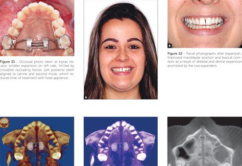 Figure 1 From Non Surgical Treatment Of Transverse Deficiency In Adults