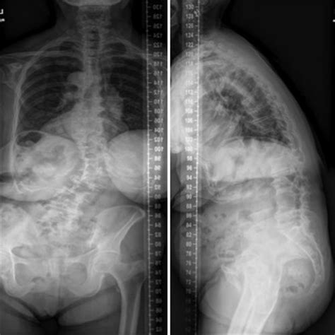 Srs Schwab Asd Classification Grades At Baseline Download Table