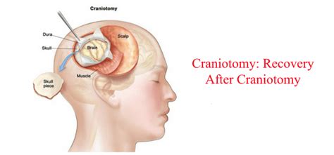 Craniotomy Recovery After Craniotomy Medmonks
