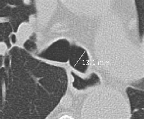 Double Lumen Tube Sizing Guide Sunny S Lou