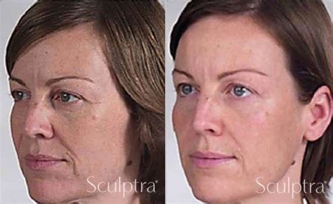Sculptra Facial Tratamientos Central Klinic