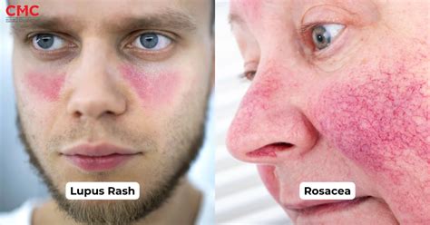 Lupus Symptoms Rash On Face