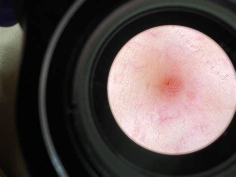 Heystetik Benjolan Di Pipi