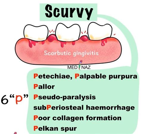 Scurvy Causes Symptoms Treatment And Prevention Dr S0 Mikaye
