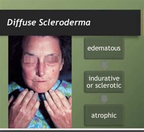 [โปรตีนอุดตัน] ความแข็งก่อให้เกิดความทุกข์ ตอนที่ 1 โรคผิวหนังแข็ง Scleroderma Sclero ความแข็ง