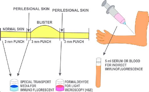 Biopsy Procedure For Vb Lesions Modifi Ed From Kumaraswamy Et Al Oral Download Scientific