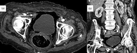 Emphysematous Cystitis Emphysematous Cystitis Radiology Key