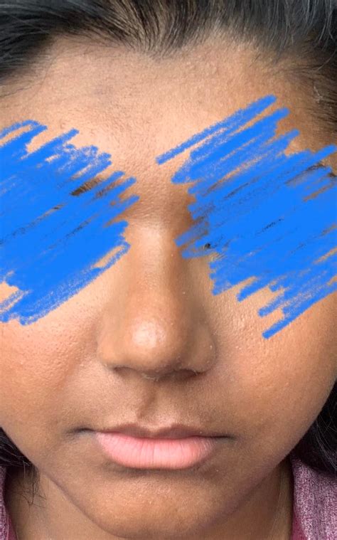 Rhinoplasty Swelling And Shape Encouragement R Rhinoplastycommunity