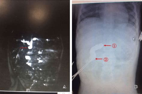 A Mrcp Examination The Arrows Indicate Anastomotic Stenosis After Download Scientific Diagram
