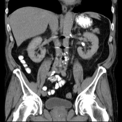 Nephrolithiasis Amboss Do Outcomes Of Percutaneous Nephrolithotomy In