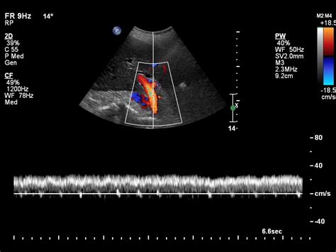 Liver Doppler Ultrasound Pulsatility In Portal Vein Flow — Swissnephro