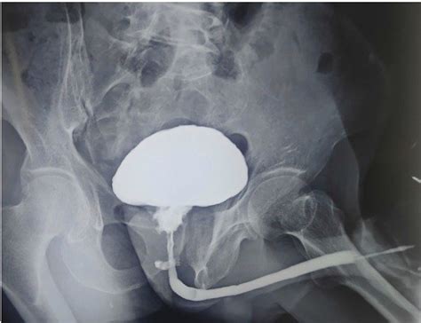 Micturating Cysto Urethrogram Mcug Chemhealth Diagnostics