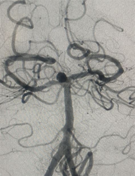 A Basilar Tip Aneurysm Causing Sah Mustafa Özdemir