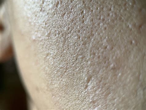 How To Reduce Bump On Forehead Conquer Those Unwanted Bumps How To