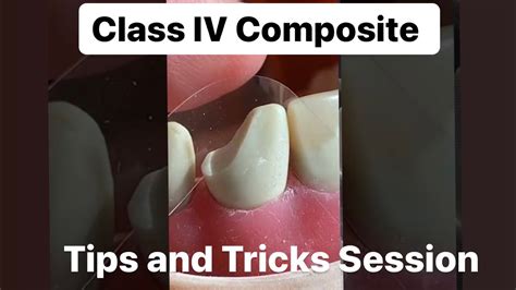 Class Iv Composite Tips And Tricks Session Youtube