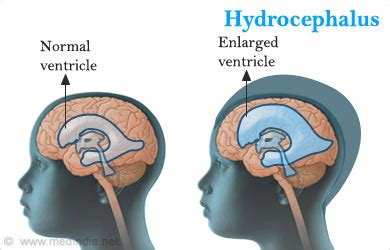Hydrocephalus What Causes Too Much Fluid On The Brain Challenging