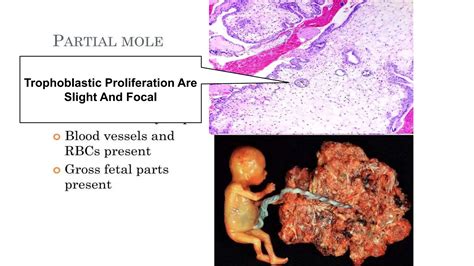 Gestational Trophoblastic Disease Gtd Molar Pregnancy Gestational