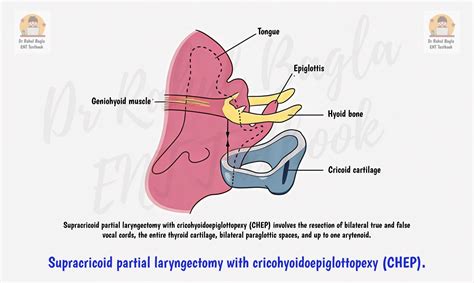 Conservation Surgeries For Carcinoma Larynx Link Conservation