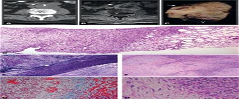 Intimal Sarcoma Of The Abdominal Aorta Presenting As A Retro Pathology Journal Of The Rcpa