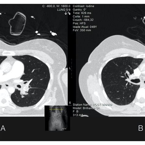 Angiografia Pulmonar Por Tomografia Computadorizada Mostrando