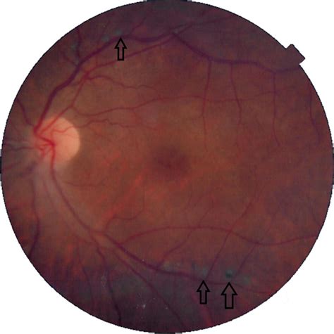 Presumed Tubercular Multifocal Choroiditis Pmc