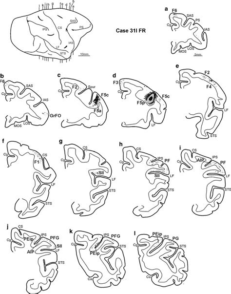 Distribution Of Retrograde Labeling Observed In Case 31l Shown In
