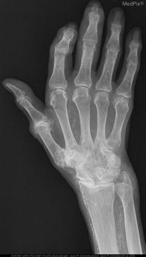 John Cush On Linkedin Mgh Study Compared 1148 Acute Cppd Vs 3730