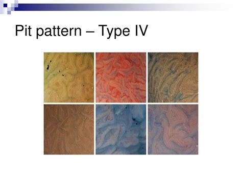 Ppt Pit Pattern Classification In Colonoscopy Powerpoint Presentation