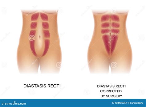 Diastasis Recti Abdominal Separation Medical Vector Illustration