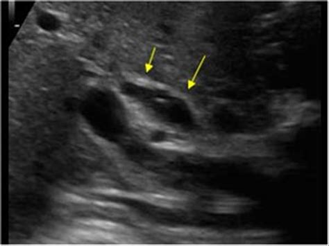 Abdomen And Retroperitoneum 1 2 Gallbladder And Bile Ducts Case 1 2