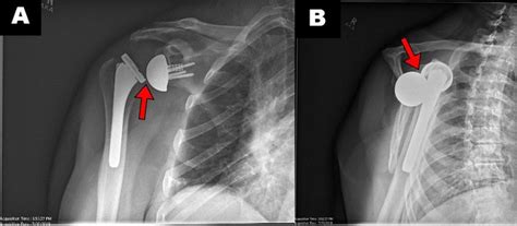 A 60 Year Old Male With Reverse Shoulder Arthroplasty Dislocation