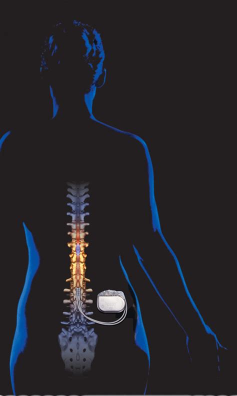 Spinal Cord Stimulation How Scs Works The Kraus Back And Neck Institute