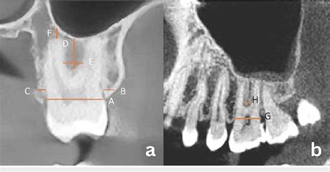 Maxillary Molar Measurement Using Cbct Scan A Coronal Section B